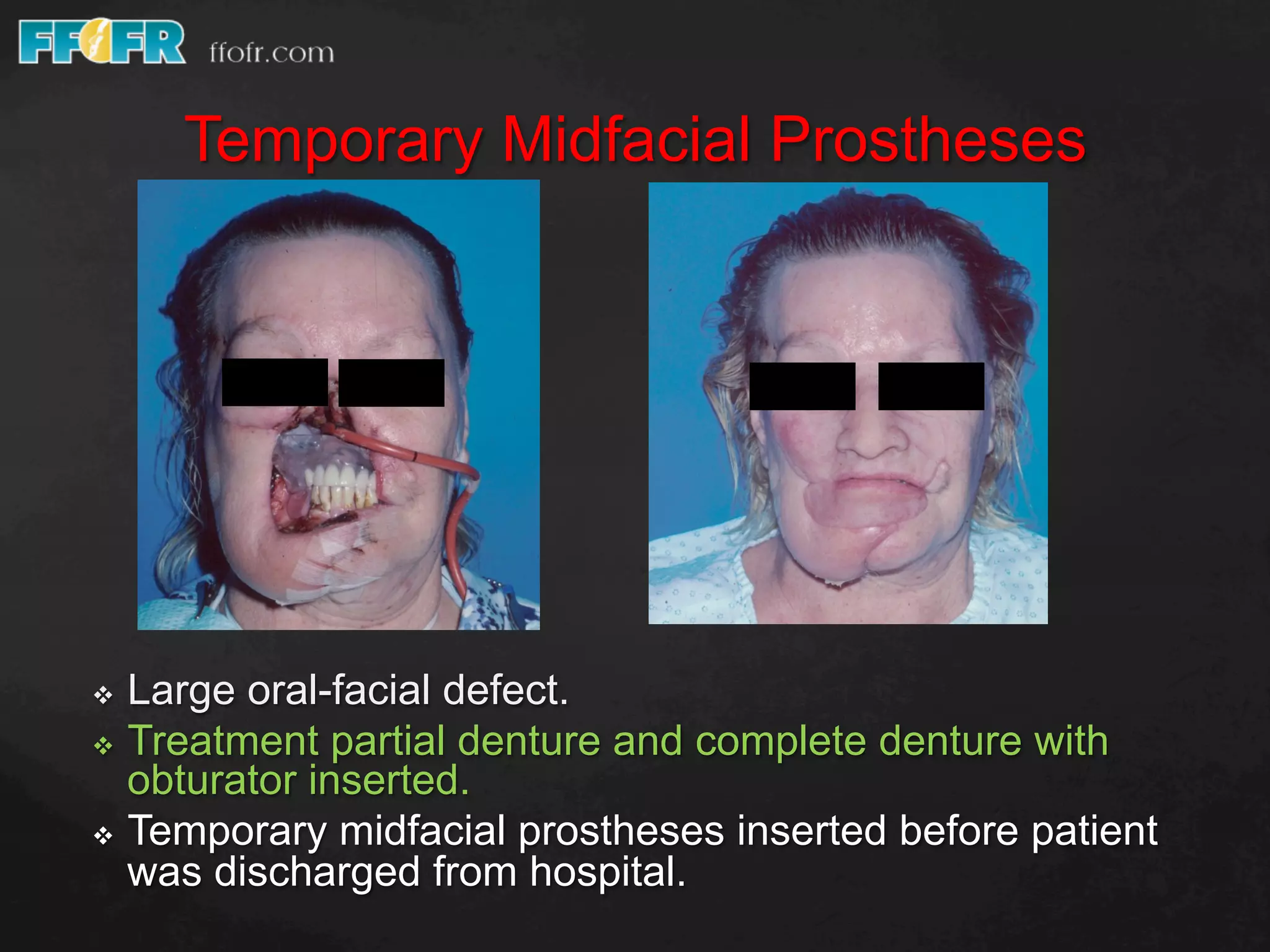Restoration of midfacial defects | PDF