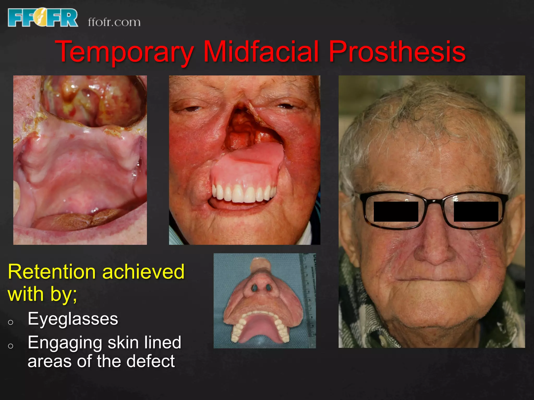 Restoration of midfacial defects | PDF