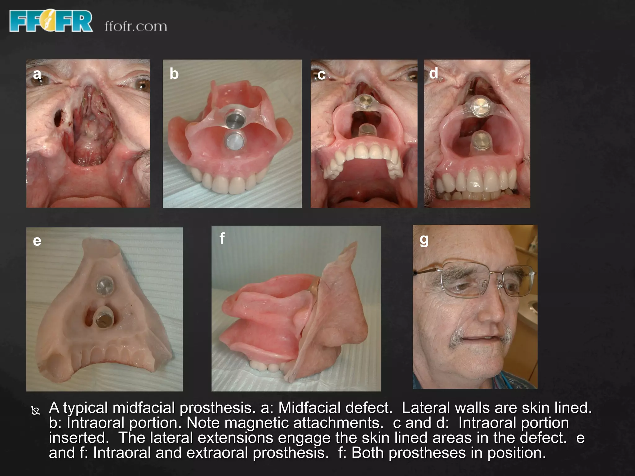 Restoration of midfacial defects | PDF