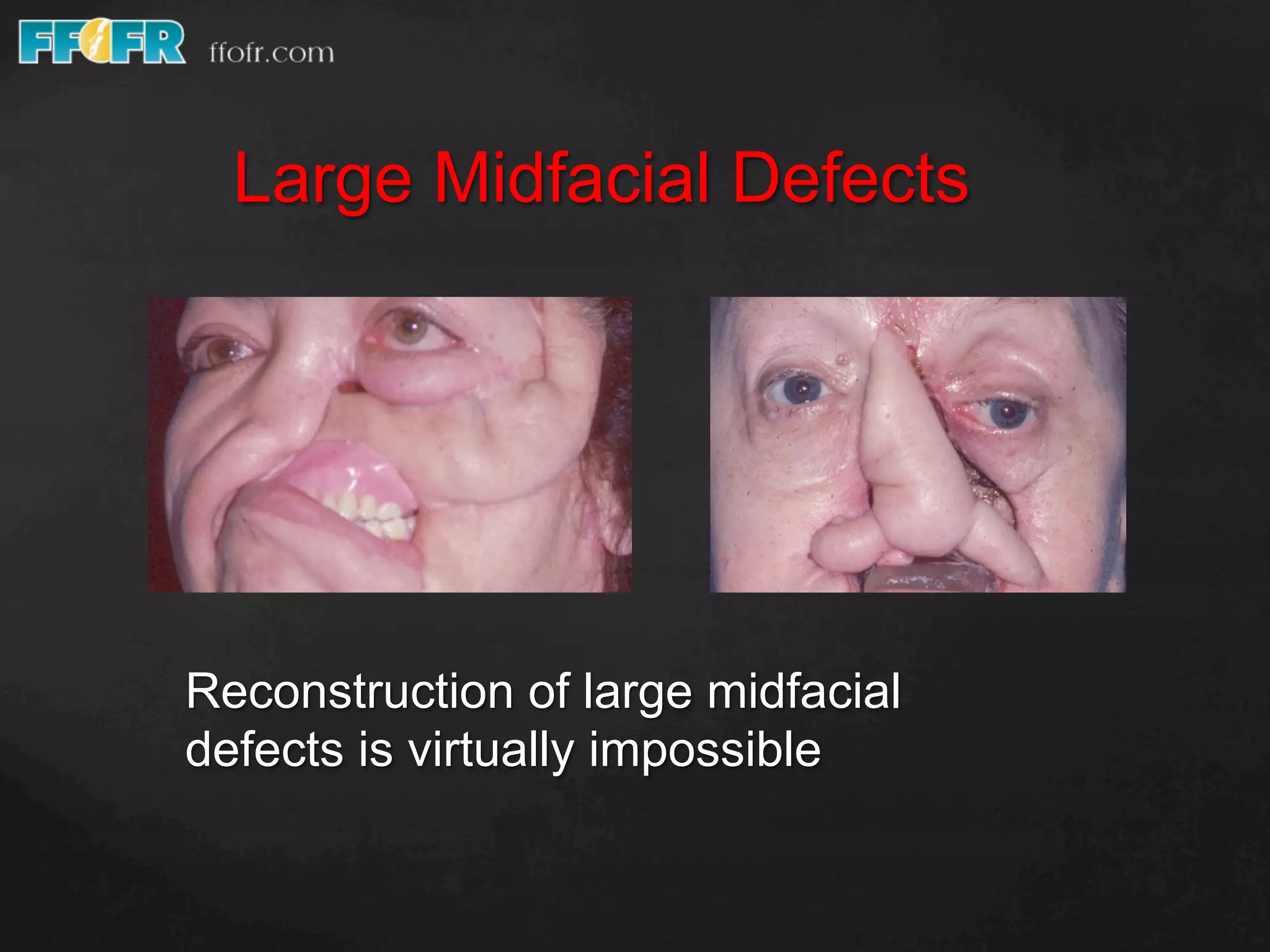 Restoration of midfacial defects | PDF