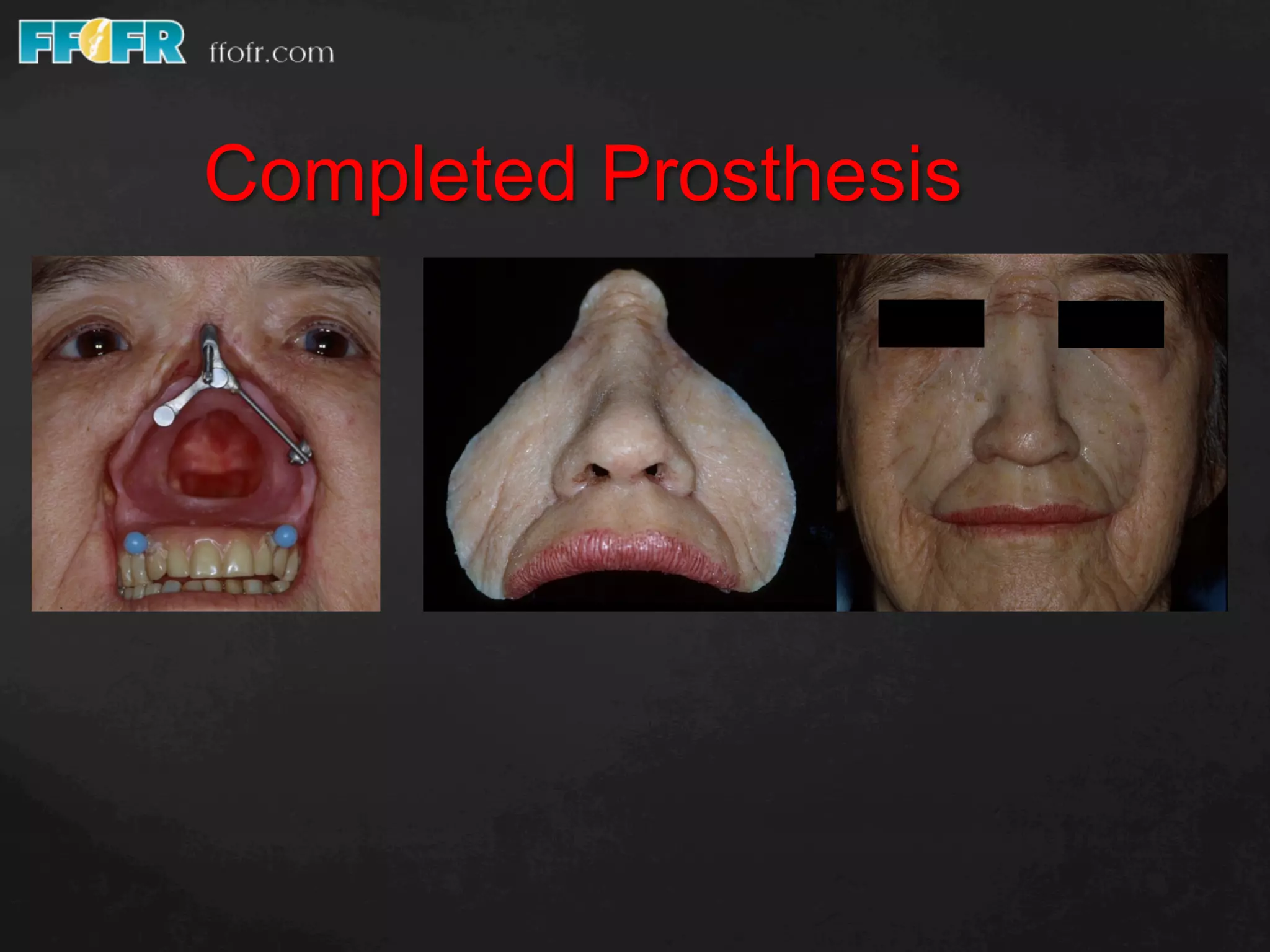 Restoration of midfacial defects | PDF