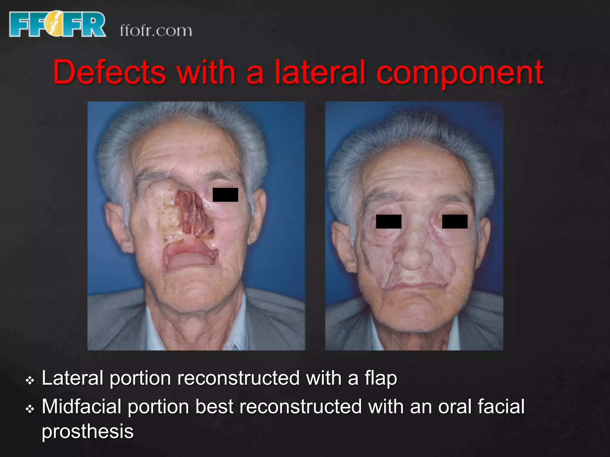 Restoration of midfacial defects | PDF