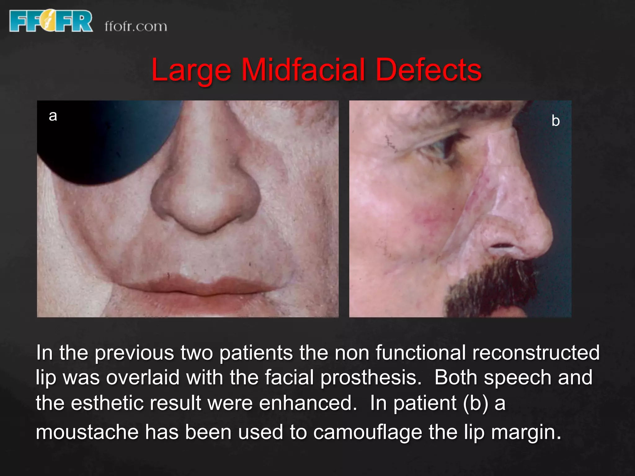 Restoration of midfacial defects | PDF