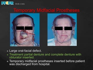 Restoration of midfacial defects | PDF