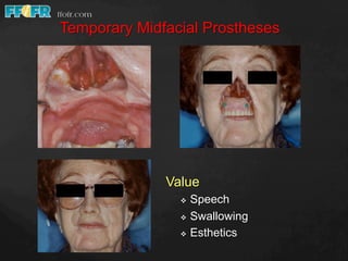 Restoration of midfacial defects | PDF