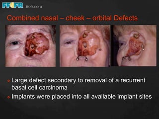 Restoration of midfacial defects | PDF