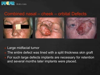 Restoration of midfacial defects | PDF