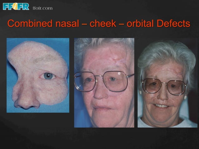 Restoration of midfacial defects | PDF