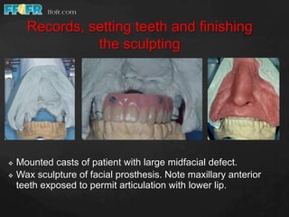 Restoration of midfacial defects | PDF
