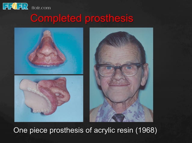 Restoration of midfacial defects | PDF