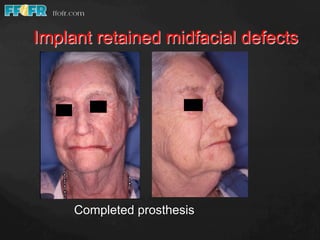 Restoration of midfacial defects | PDF