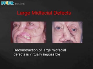 Restoration of midfacial defects | PDF