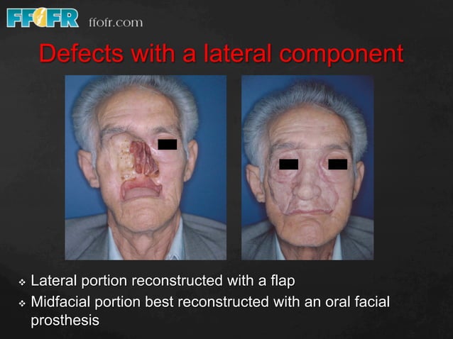 Restoration of midfacial defects | PDF
