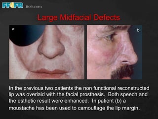 Restoration of midfacial defects | PDF
