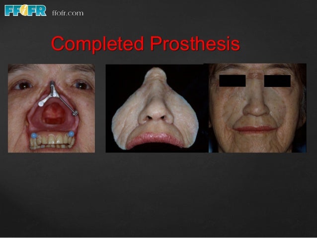 Restoration of midfacial defects