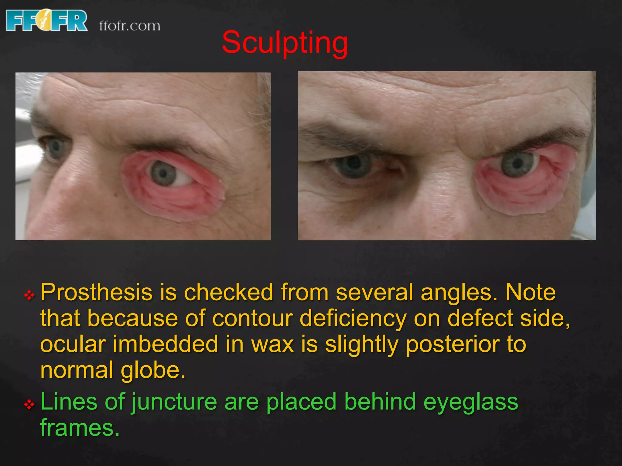 Restoration of orbital defects | PDF