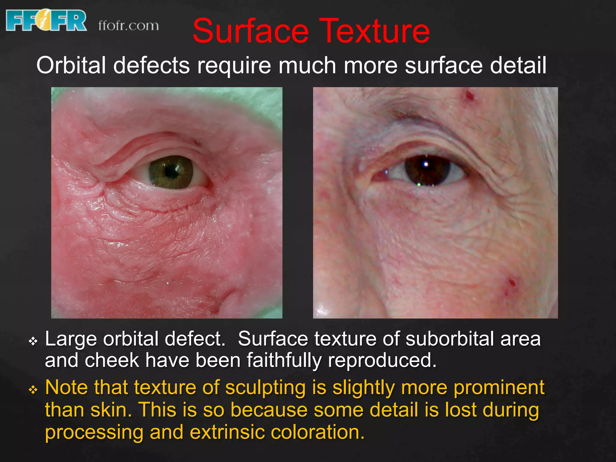 Restoration of orbital defects | PDF