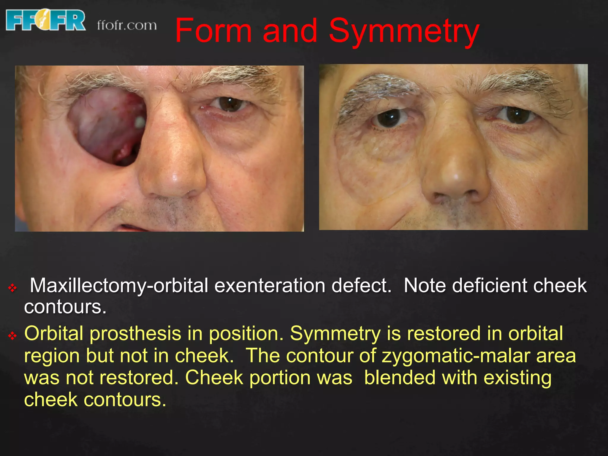 Restoration of orbital defects | PDF