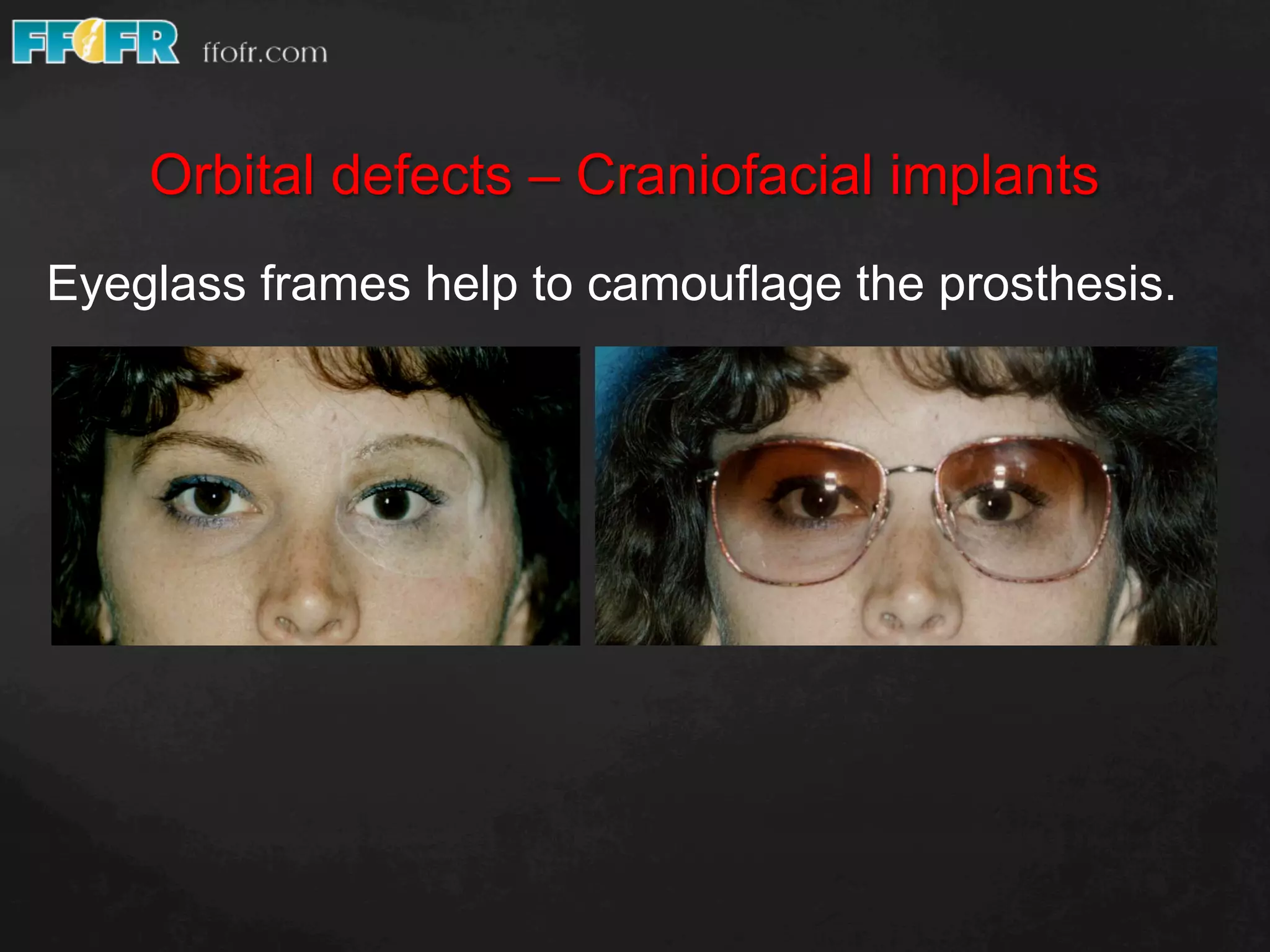 Restoration of orbital defects | PDF