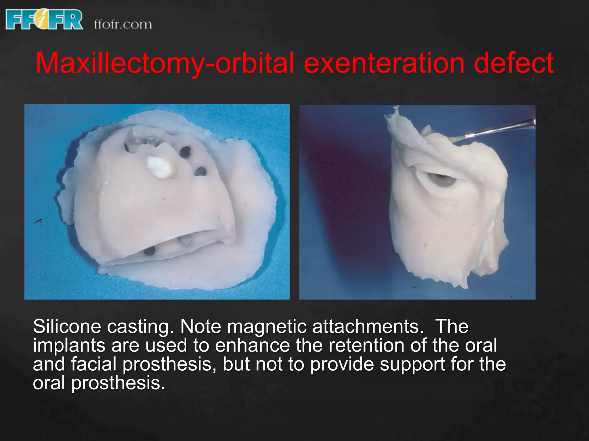 Restoration of orbital defects | PDF