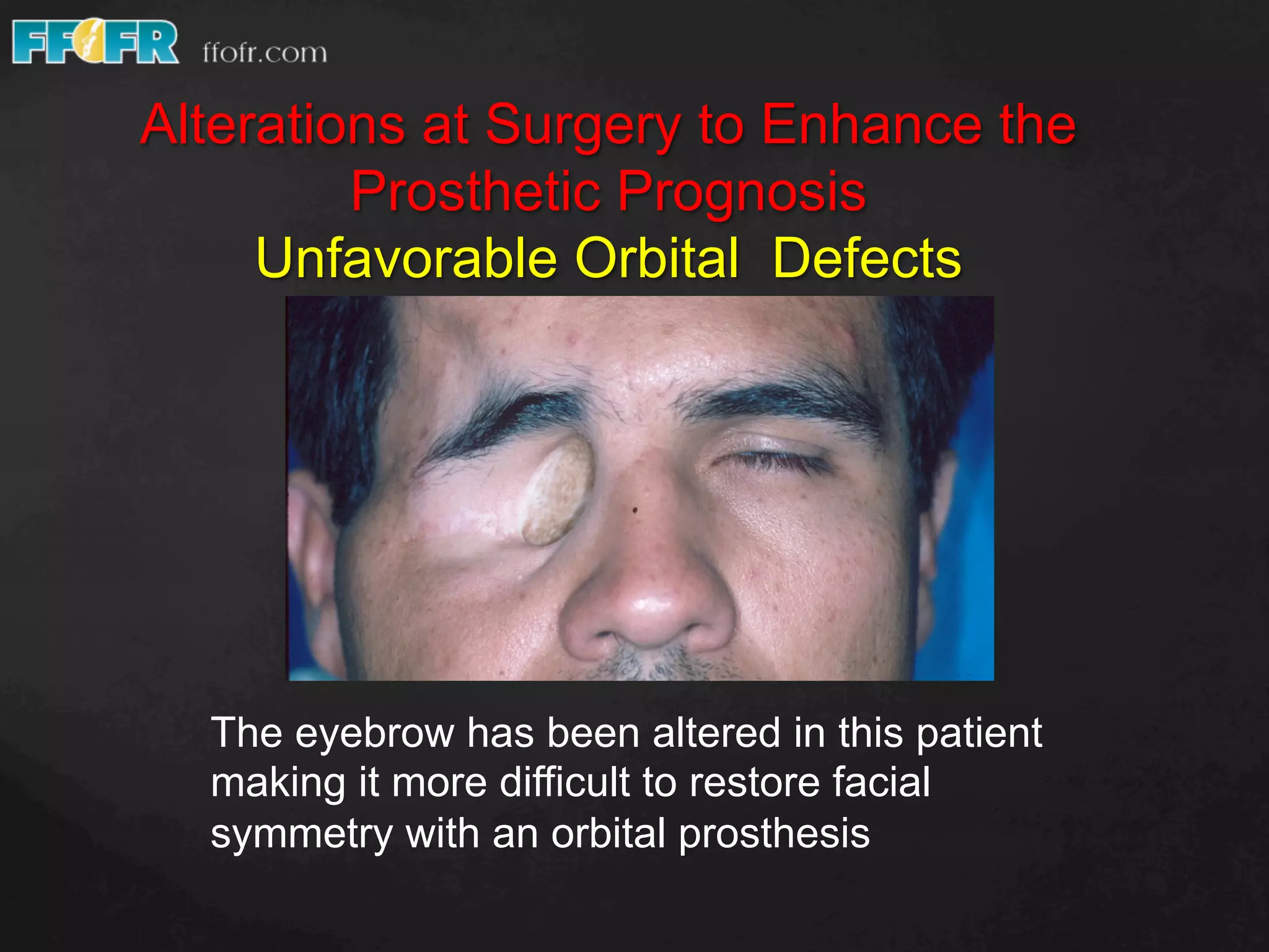 Restoration of orbital defects | PDF