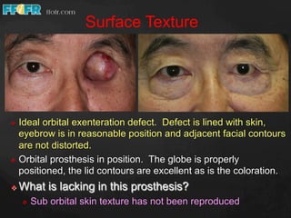 Restoration of orbital defects | PDF