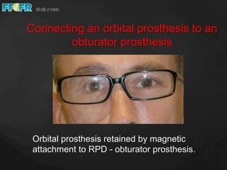 Restoration of orbital defects | PDF | Eye and Vision Conditions | Diseases and Conditions