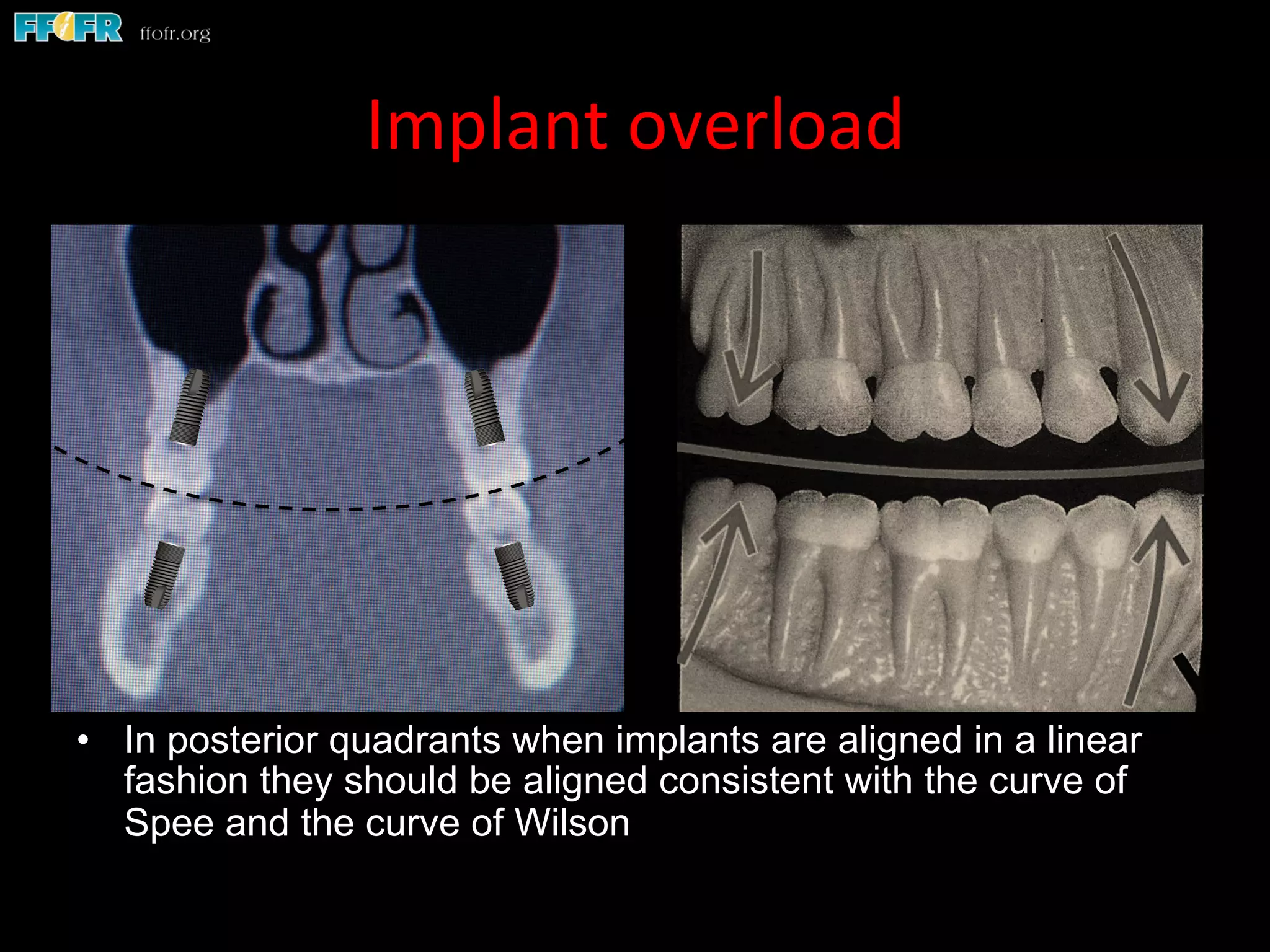 Restoration of posterior quadrants | PDF