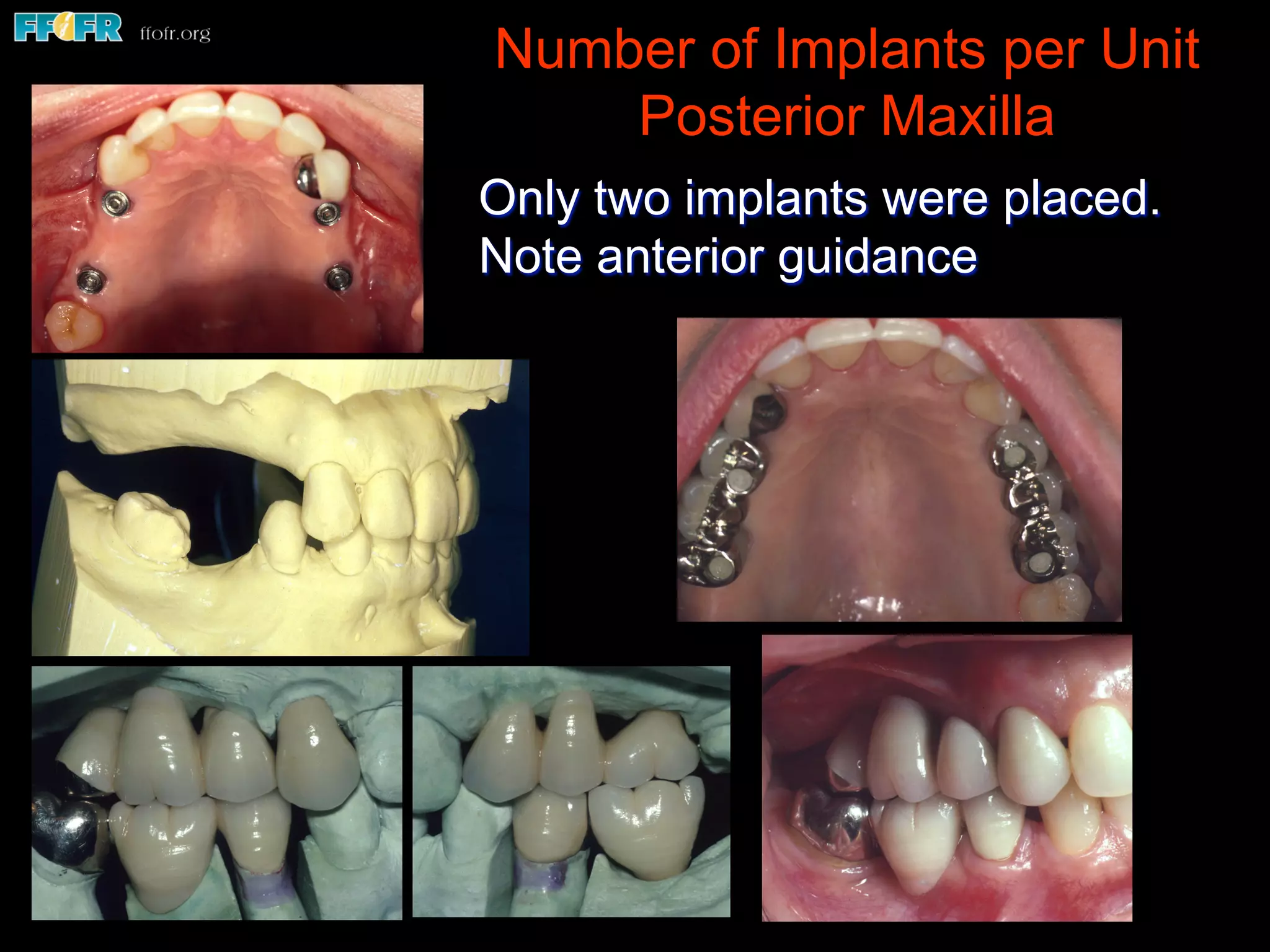 Restoration of posterior quadrants | PDF