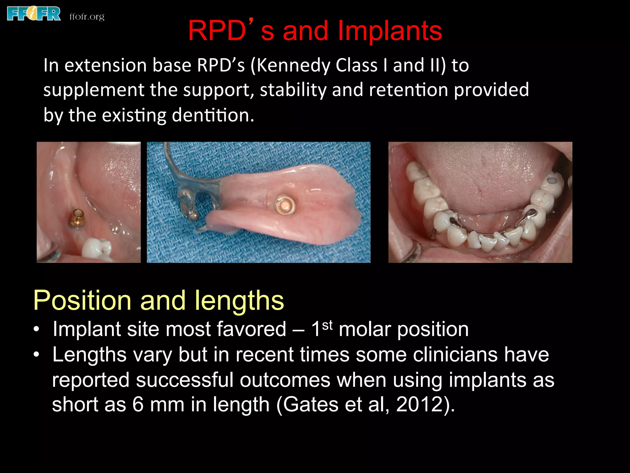 Restoration of posterior quadrants | PDF