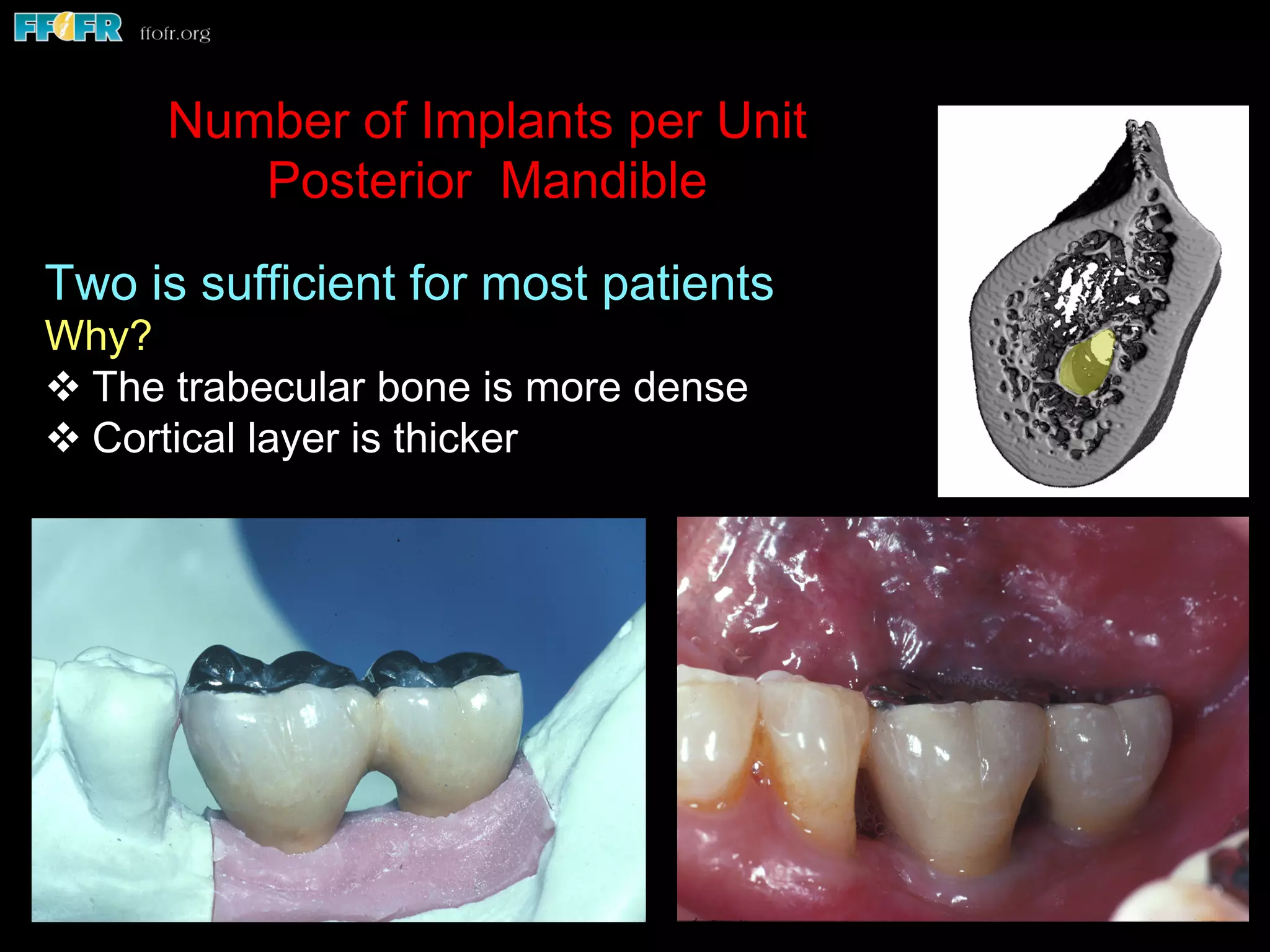 Restoration of posterior quadrants | PDF