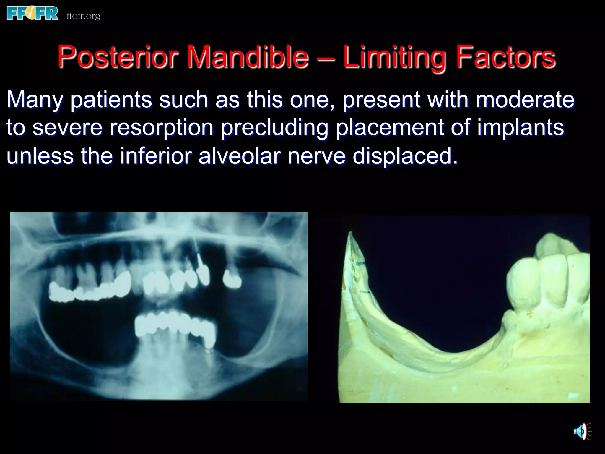 Restoration of posterior quadrants | PDF