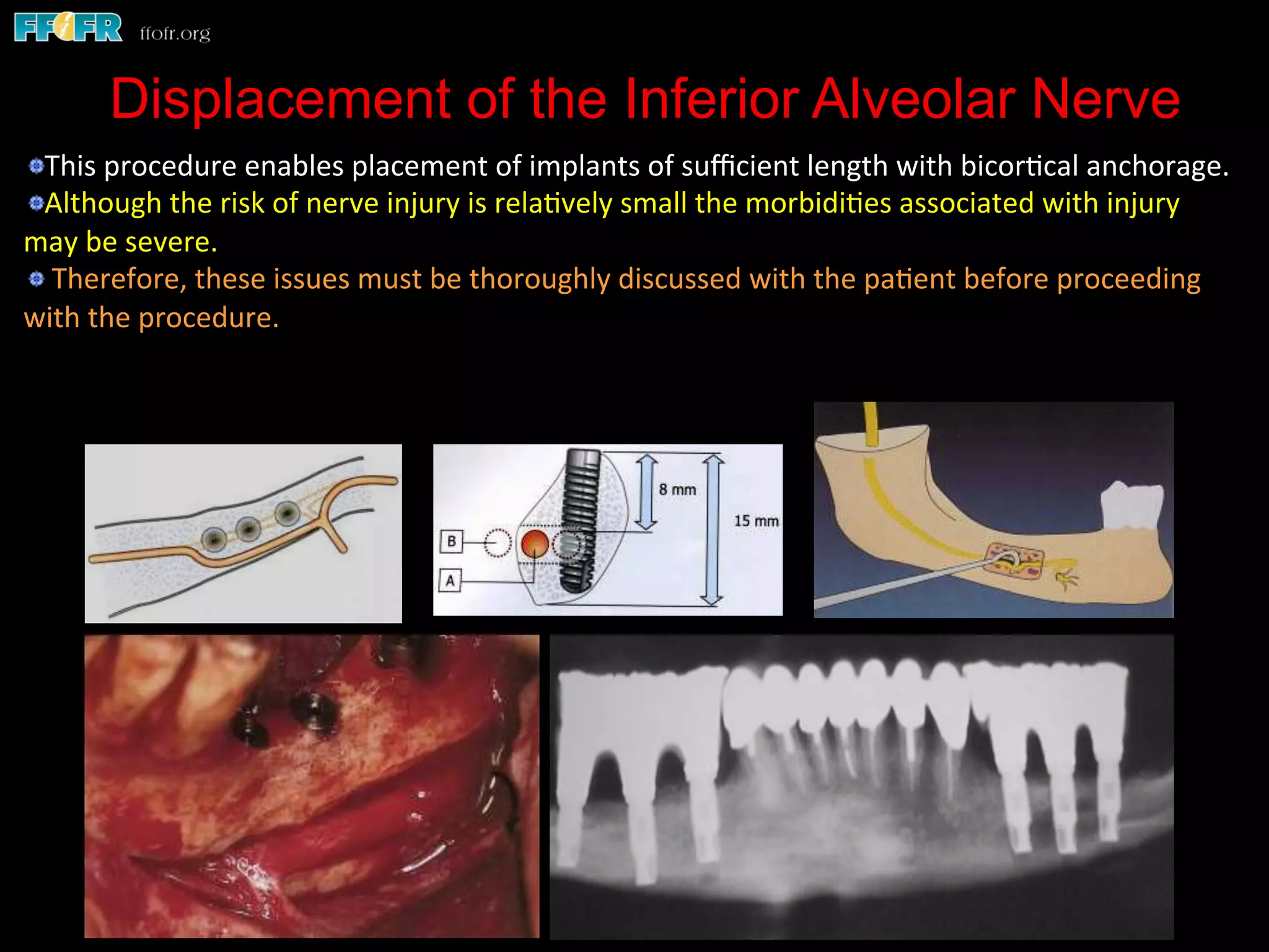 Restoration of posterior quadrants | PDF