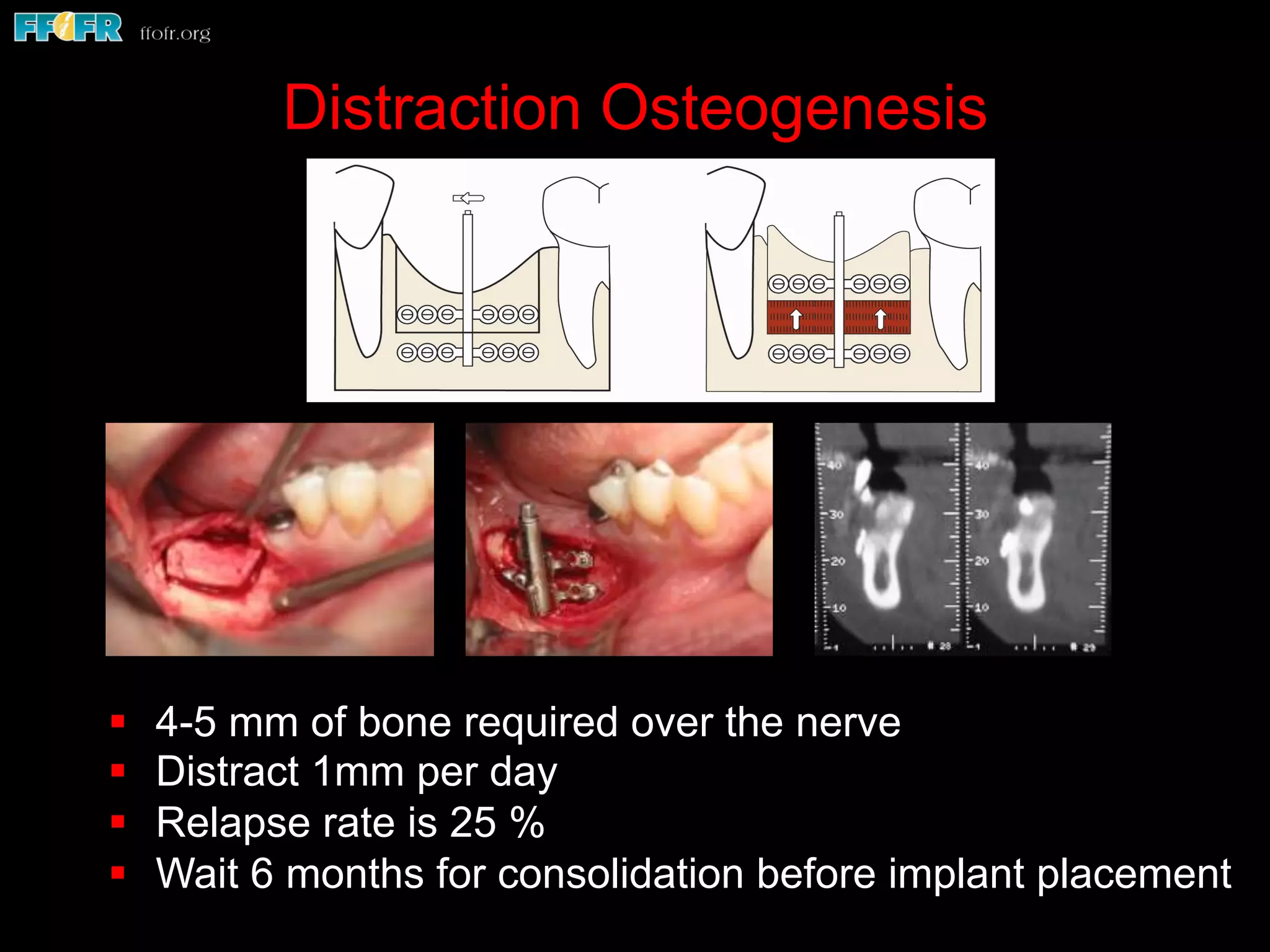 Restoration of posterior quadrants | PDF