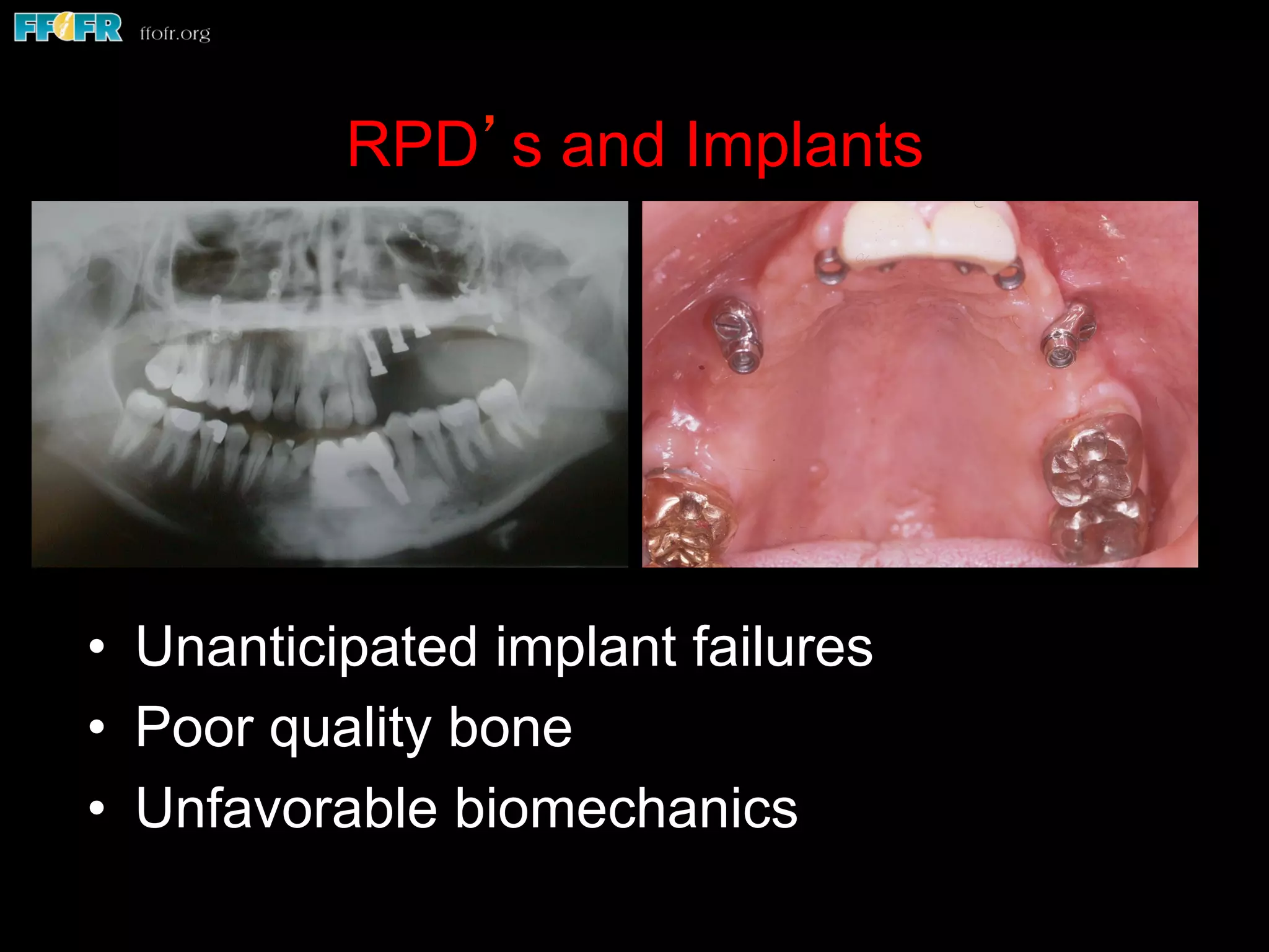 Restoration of posterior quadrants | PPT
