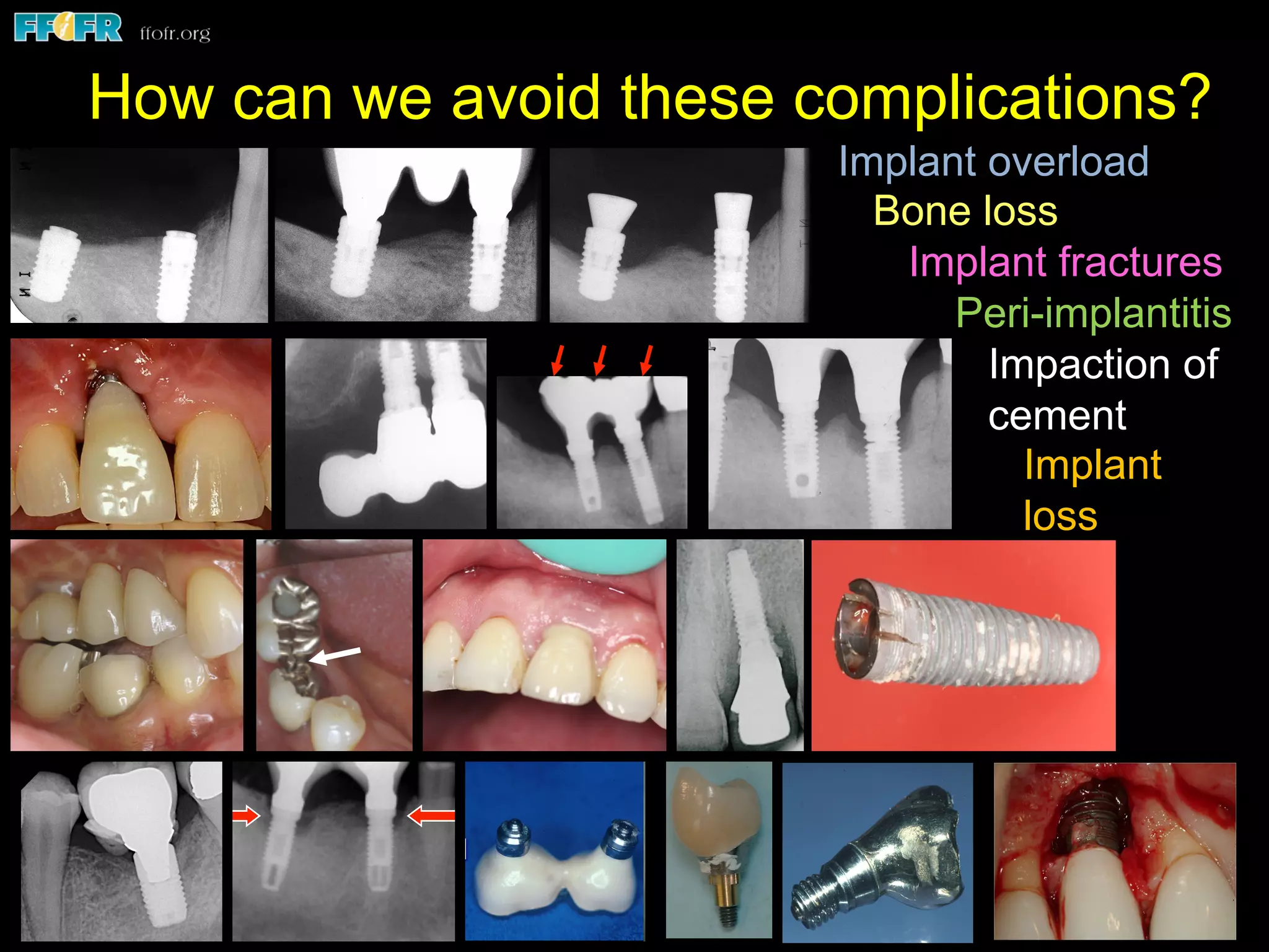Restoration of posterior quadrants | PPT