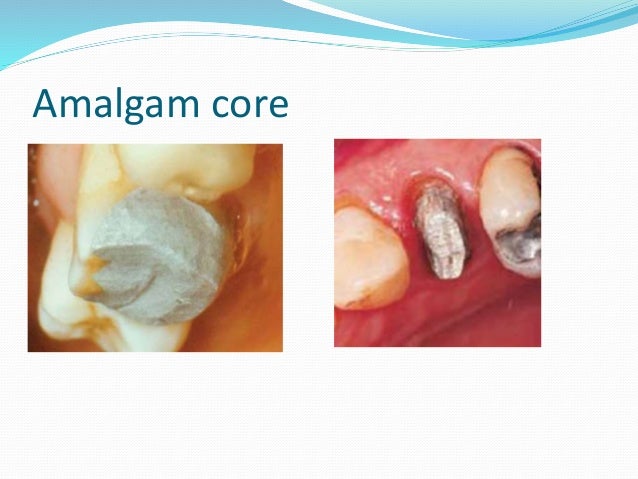 Restoration of the endodontically treated tooth