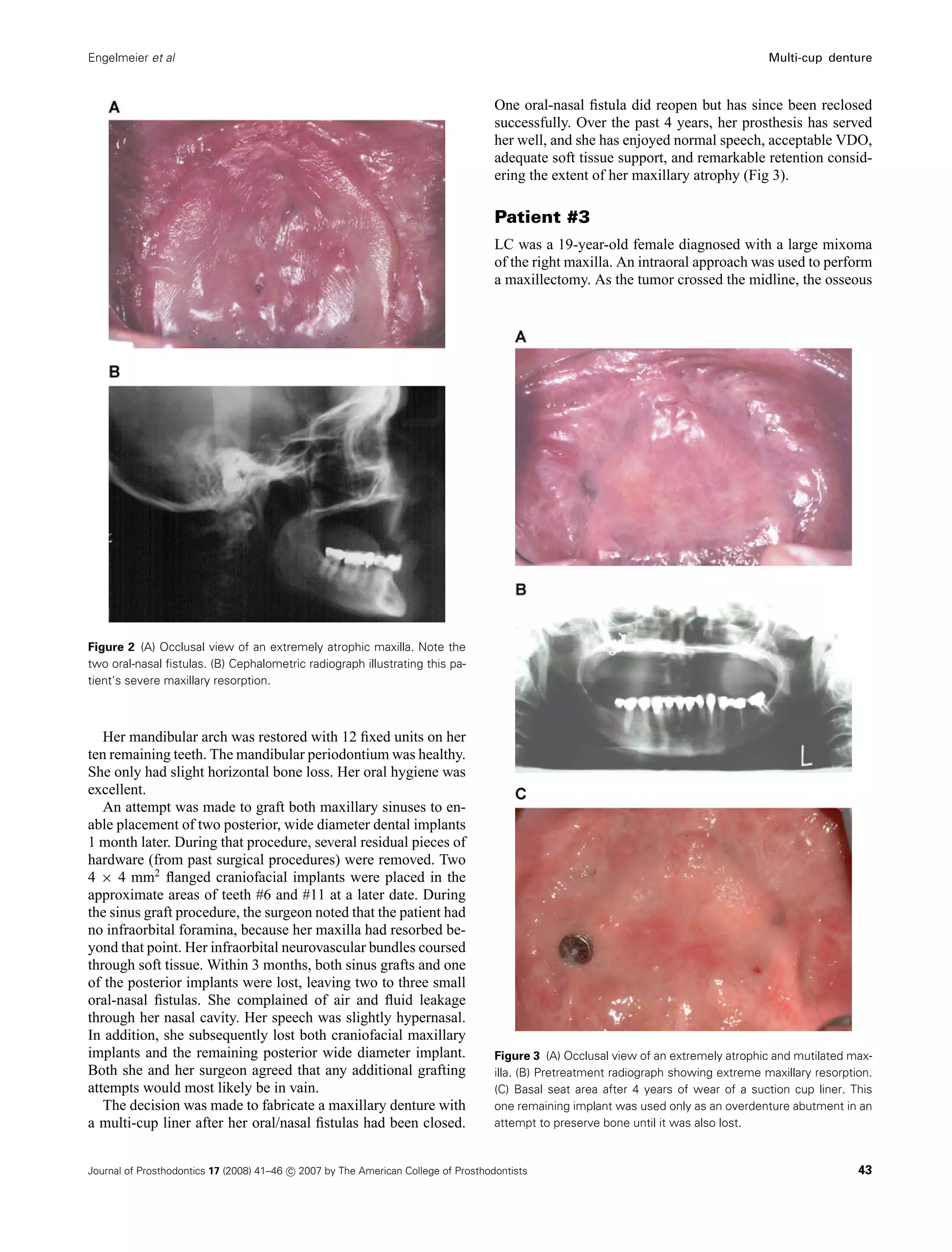 Restoration of the severely compromised maxilla using the multi cup ...