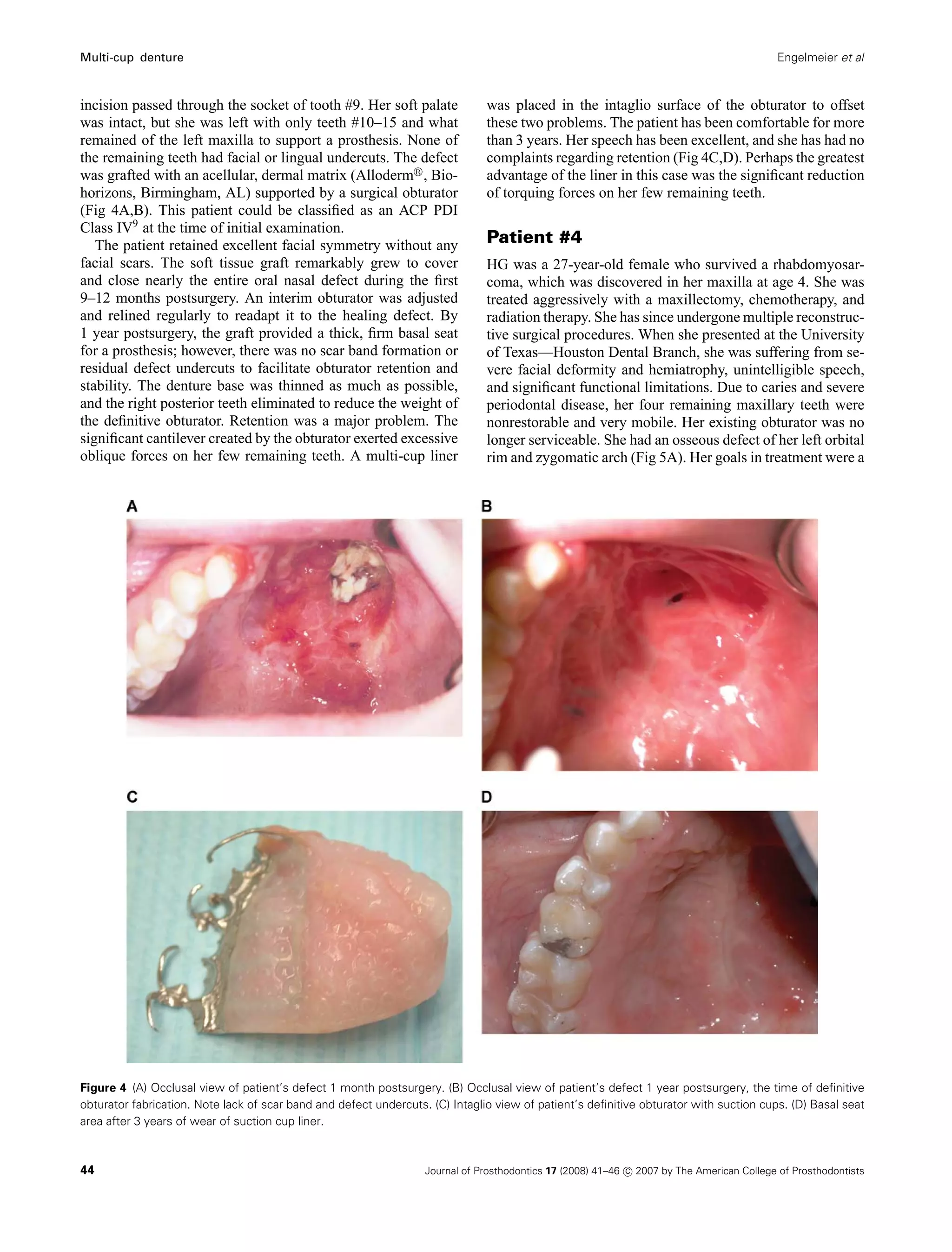 Restoration of the severely compromised maxilla using the multi cup ...