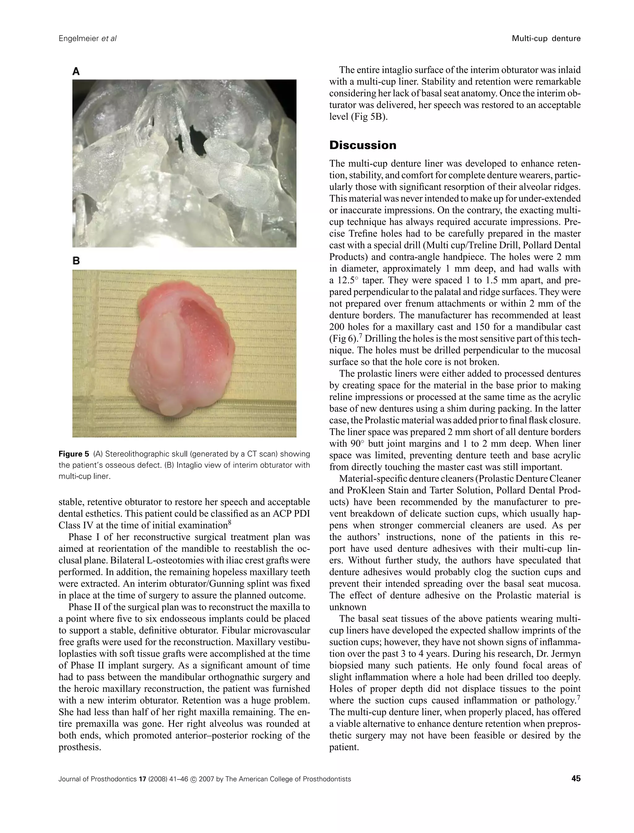 Restoration of the severely compromised maxilla using the multi cup ...