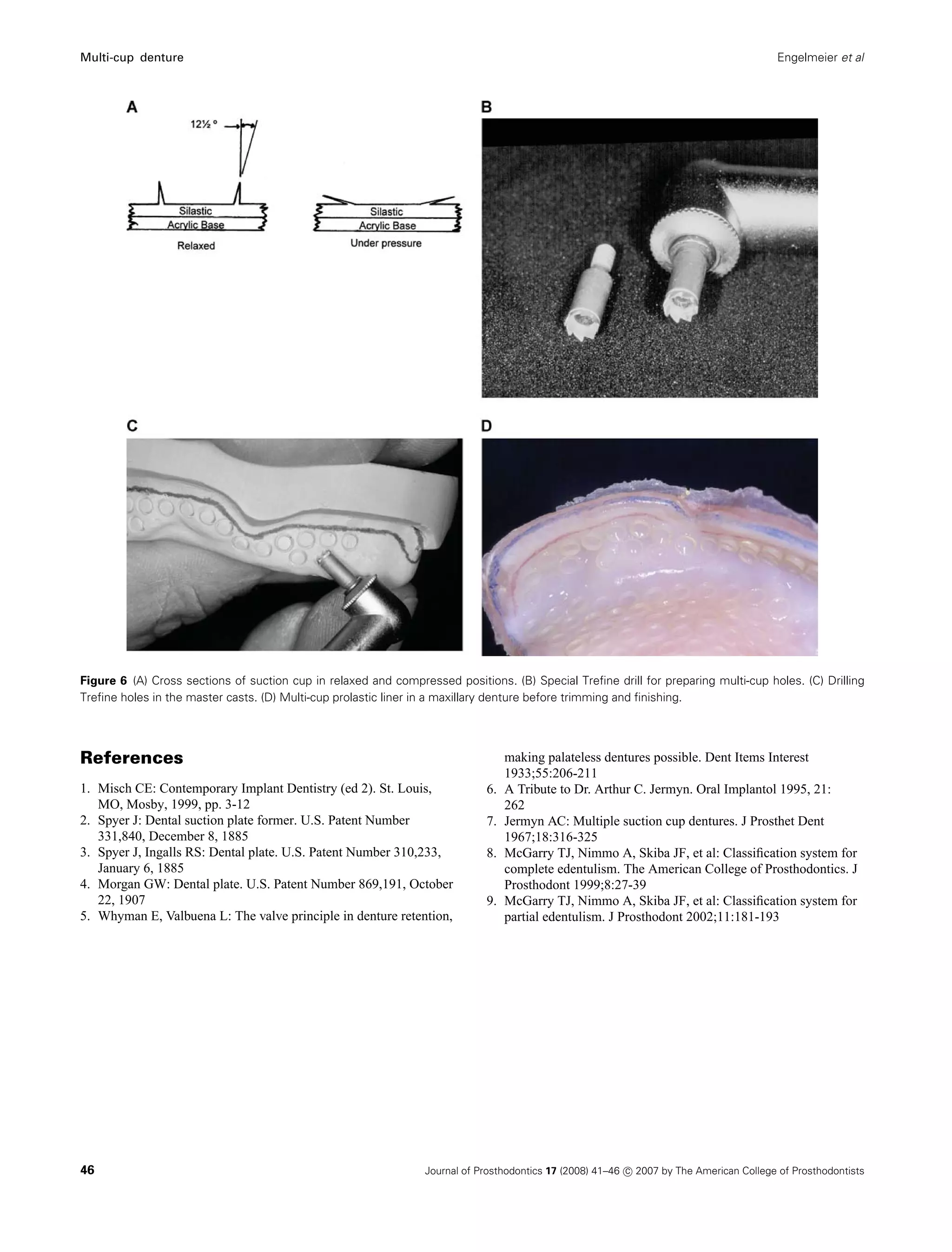 Restoration of the severely compromised maxilla using the multi cup ...