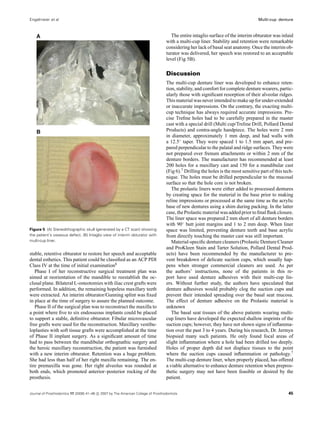 Restoration of the severely compromised maxilla using the multi cup ...