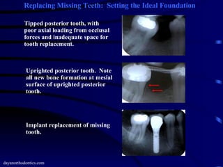 Restoring Missing Teeth & Collapsed Bite | PPT