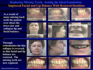 Restoring Missing Teeth & Collapsed Bite | PPT