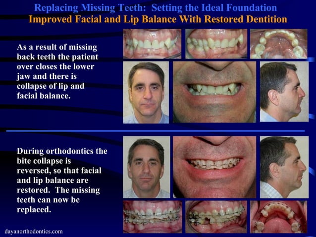Restoring Missing Teeth & Collapsed Bite | PPT