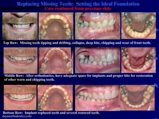 Restoring Missing Teeth & Collapsed Bite | PPT
