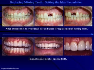 Restoring Missing Teeth & Collapsed Bite | PPT