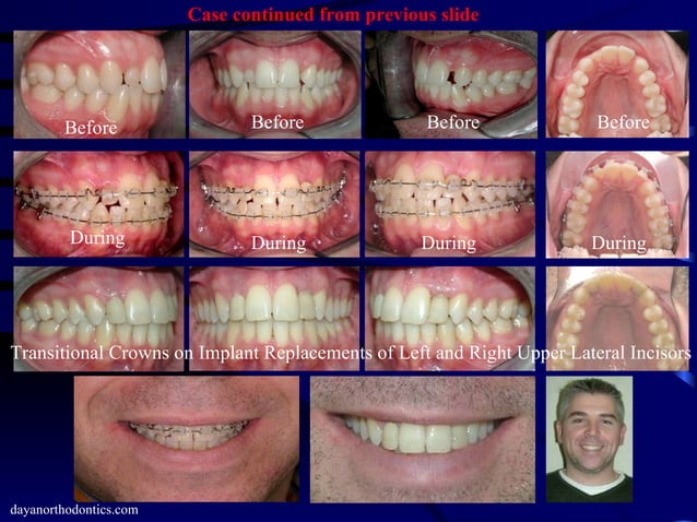 Restoring Missing Teeth & Collapsed Bite | PPT