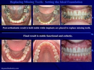 Restoring Missing Teeth & Collapsed Bite | PPT