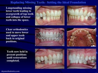 Restoring Missing Teeth & Collapsed Bite | PPT